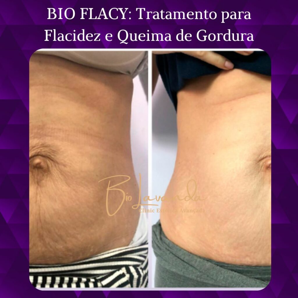 Tratamento Corporal - Bio Lavanda Clinic